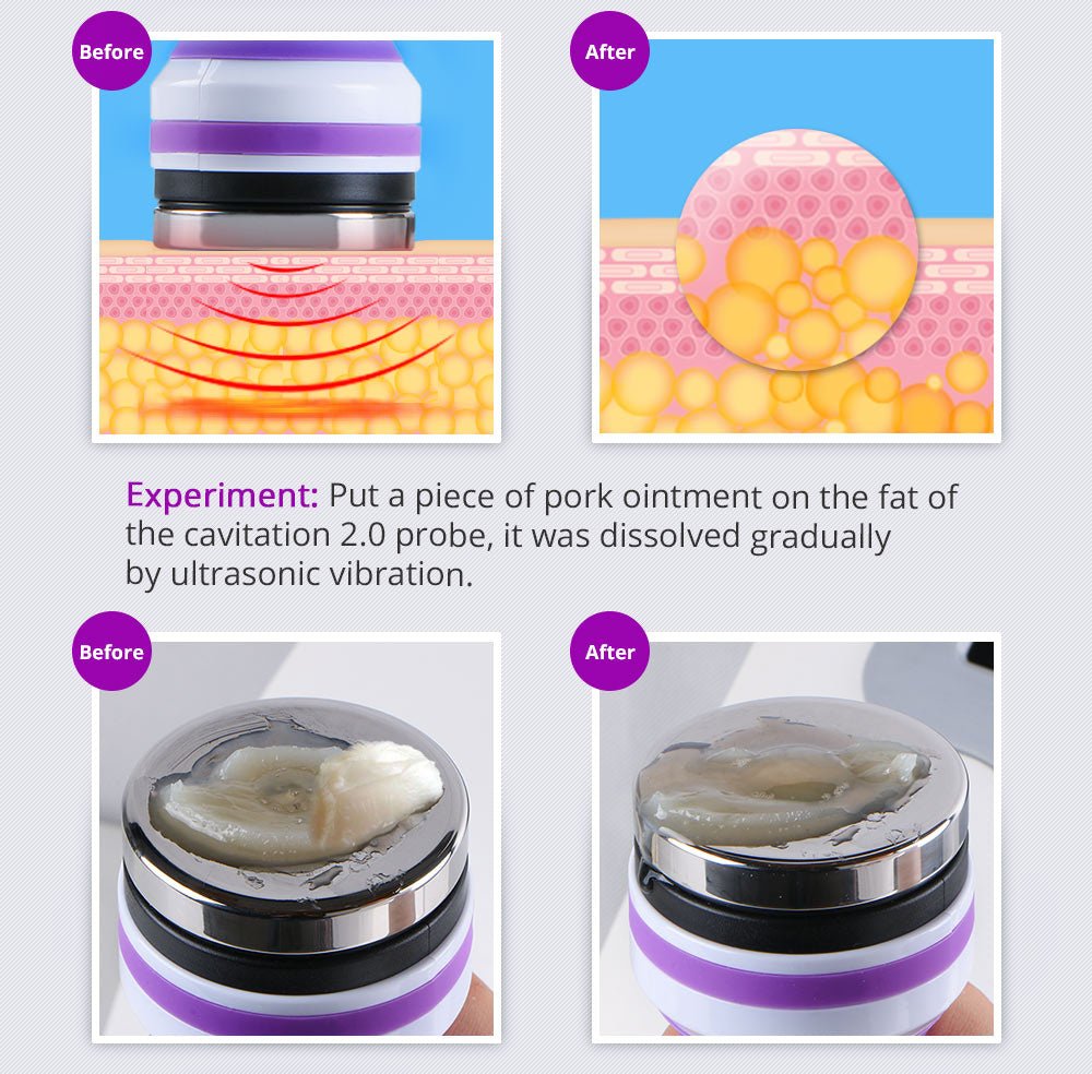 Shape Tactics 6-in-1 Cavitation LED Laser Lipo & RF Body Sculpting ...